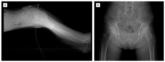 Cyberknife Radiosurgery for Prostate Cancer after Abdominoperineal ...