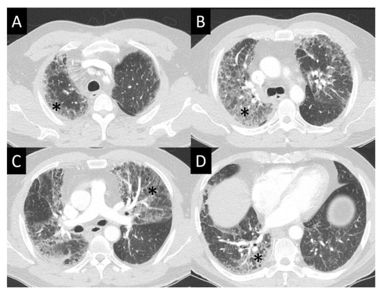 Managing the Risk of Lung Toxicity with Trastuzumab Deruxtecan (T-DXd ...