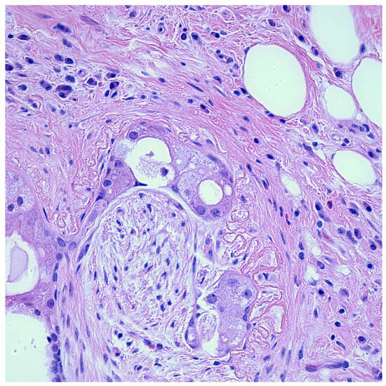 Current Oncology | Free Full-Text | Unraveling the Mysteries of Perineural Invasion in Benign ...