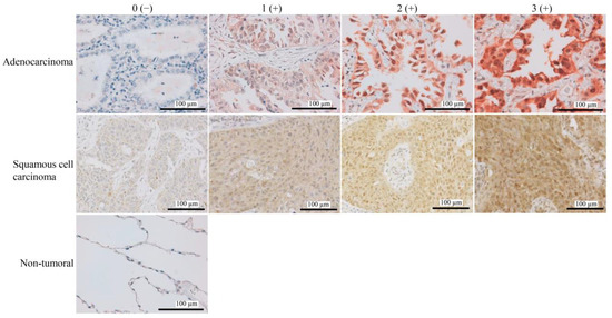 High Expression of Fas-Associated Factor 1 Indicates a Poor Prognosis ...