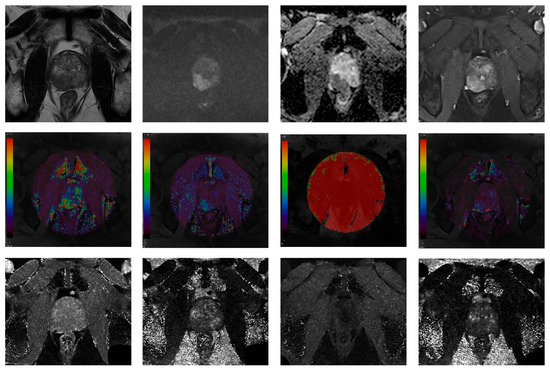 Quantitative Analysis of Prostate MRI: Correlation between Contrast-Enhanced Magnetic Resonance ...
