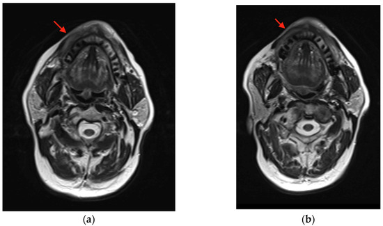 Treatment Response of Gingival Squamous-Cell Carcinoma to Palliative ...