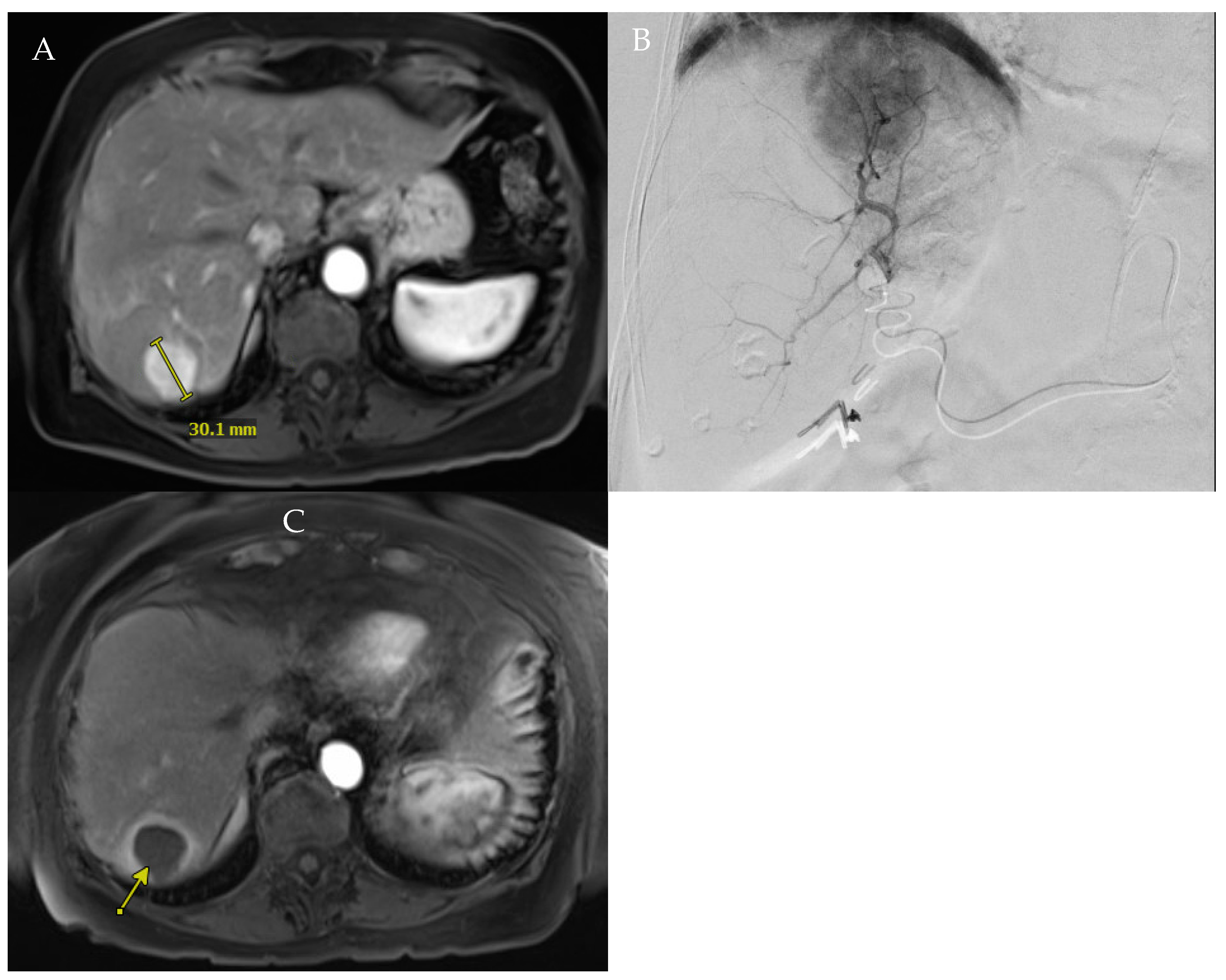 Radiation Segmentectomy for Hepatocellular Carcinoma