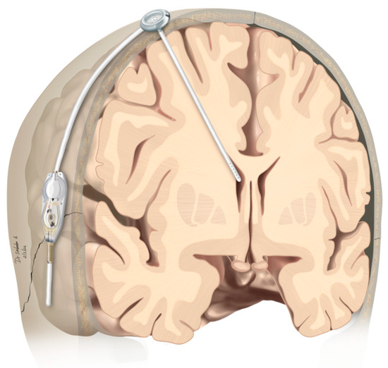 Patients with Leptomeningeal Carcinomatosis and Hydrocephalus ...