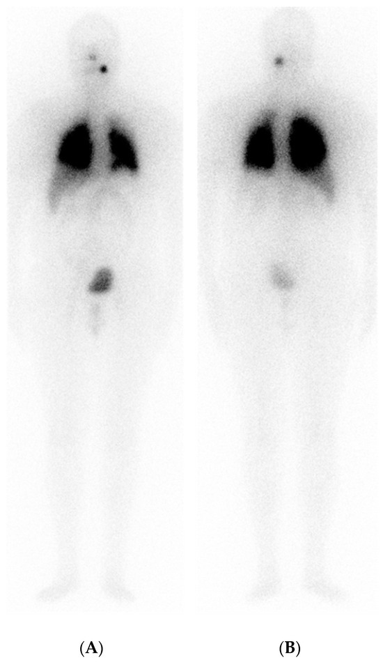 Current Advances in Radioactive Iodine-Refractory Differentiated Thyroid Cancer