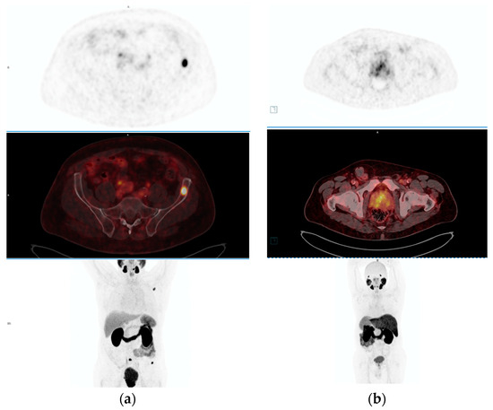 Prostate-Specific Membrane Antigen Expression in Patients with Primary ...