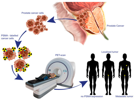 Prostate-Specific Membrane Antigen Expression in Patients with Primary ...