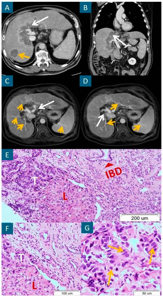 Current Oncology | Free Full-Text | An Unusual Radiologic Image of ...