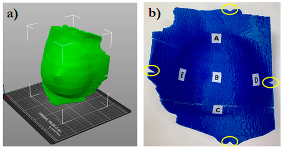 A Customized 3D-Printed Bolus for High-Risk Breast Cancer with Skin ...