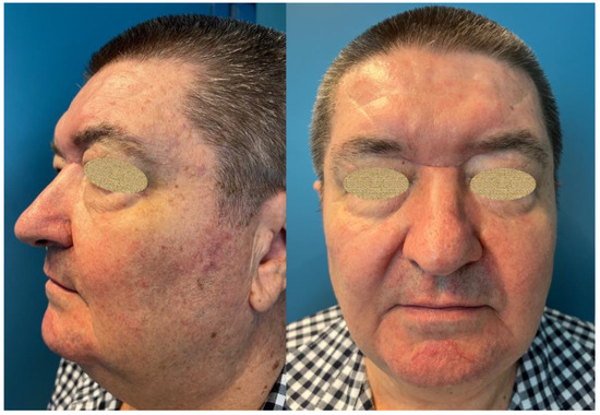 Transglabellar Butterfly Incision for Anterior Cranial Vault Access ...