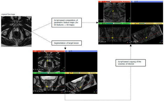 Detecting Clinically Significant Prostate Cancer in PI-RADS 3 Lesions ...