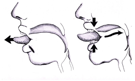 Prophylactic Swallowing Exercises in Patients with Laryngeal Cancer Who ...