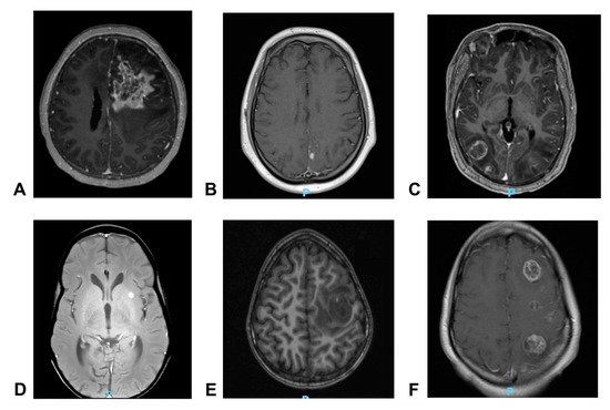 Brain Metastasis in Pediatric Patients with Osteosarcoma