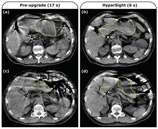 Evaluating CBCT-Guided Adaptive Radiotherapy for Pancreatic Cancer ...