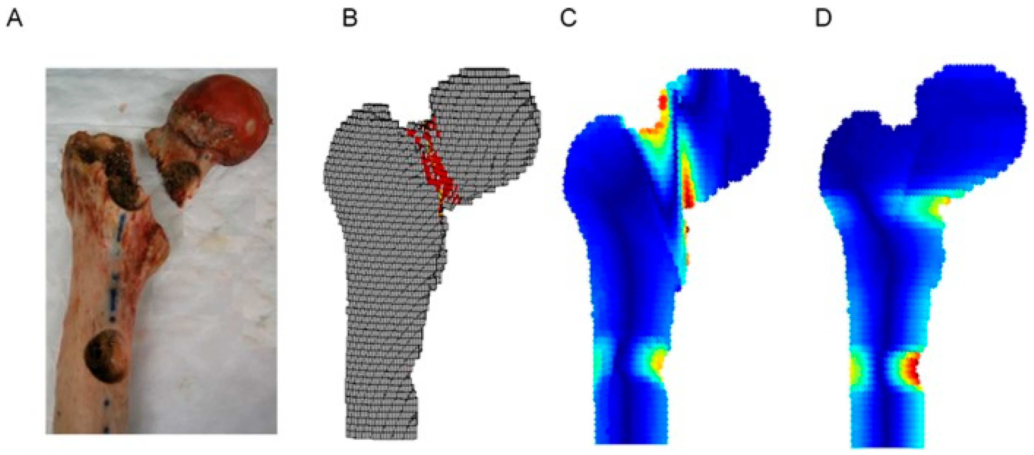 Predicting the Risk for Pathological Fracture in Bone Metastases