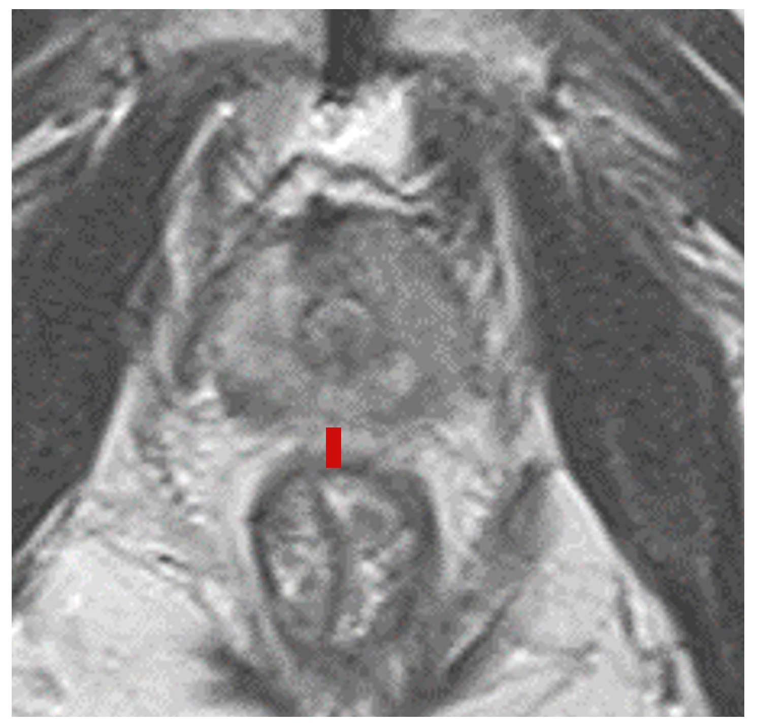 Patients with a Short Distance Between the Prostate and the Rectum Are ...