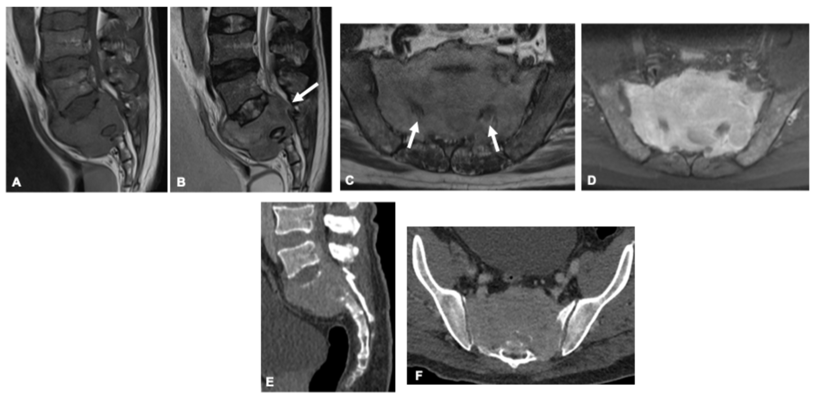 Beyond Chordoma: A Comprehensive Review of Sacral Lesions