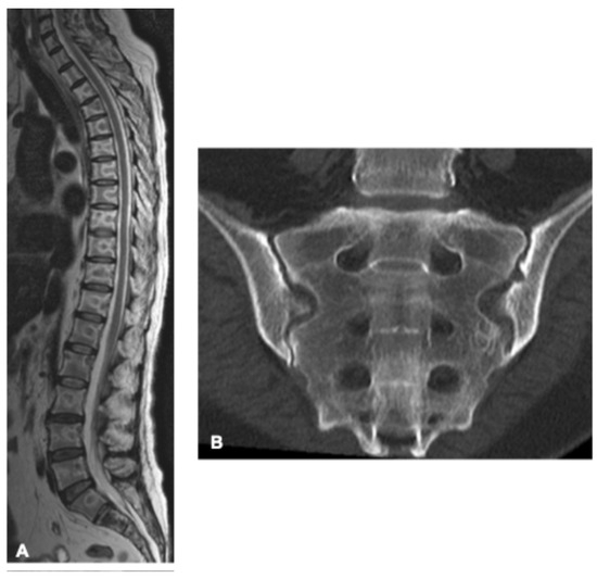 Beyond Chordoma: A Comprehensive Review of Sacral Lesions