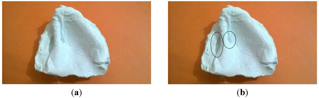 Oronasal Fistula and Complete Edentulism: What to Do?