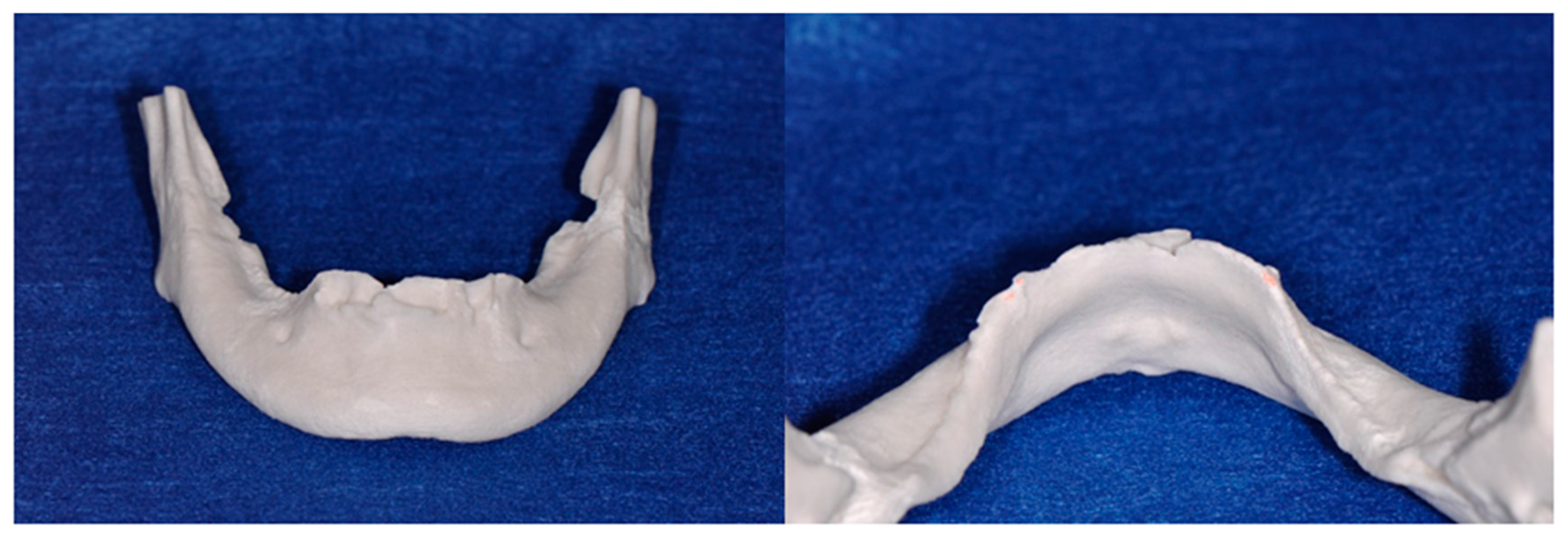 Magnet-Retained Two-Mini-Implant Overdenture: Clinical and Mechanical ...