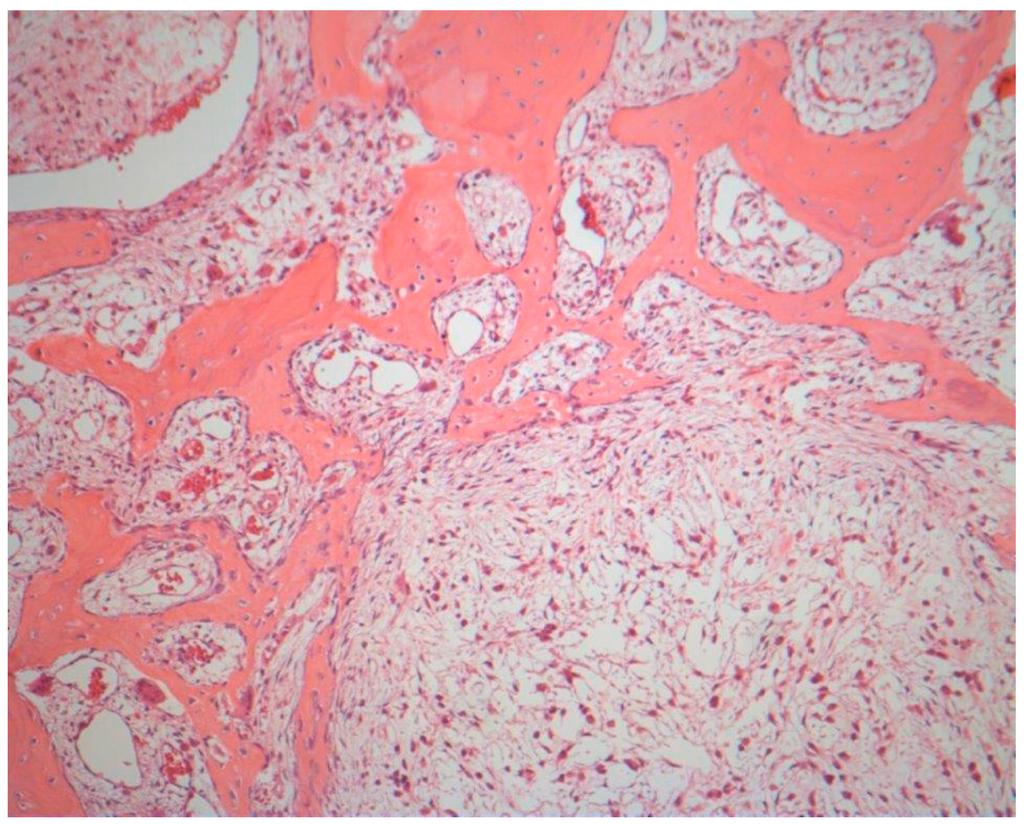 Custom Made Replacement of the Mandibular Condyle in a Case of Fibrous ...