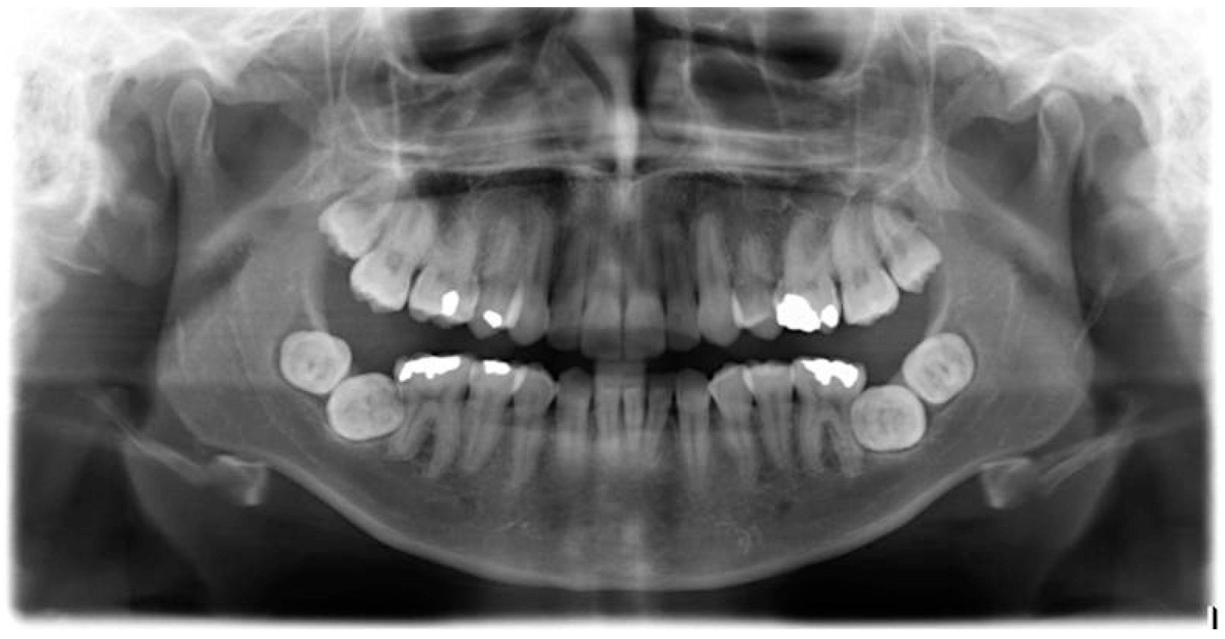 Bilateral Transverse Mandibular Second Molars: A Case Report