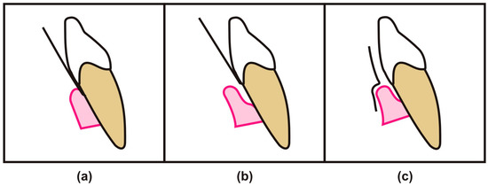 Human Gingival Crevicular Fluids (GCF) Proteomics: An Overview