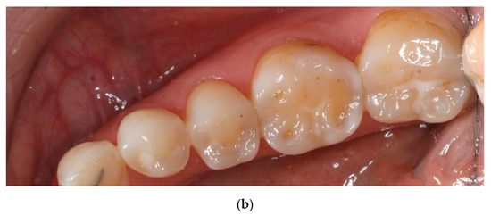 Erosive and Mechanical Tooth Wear in Viking Age Icelanders