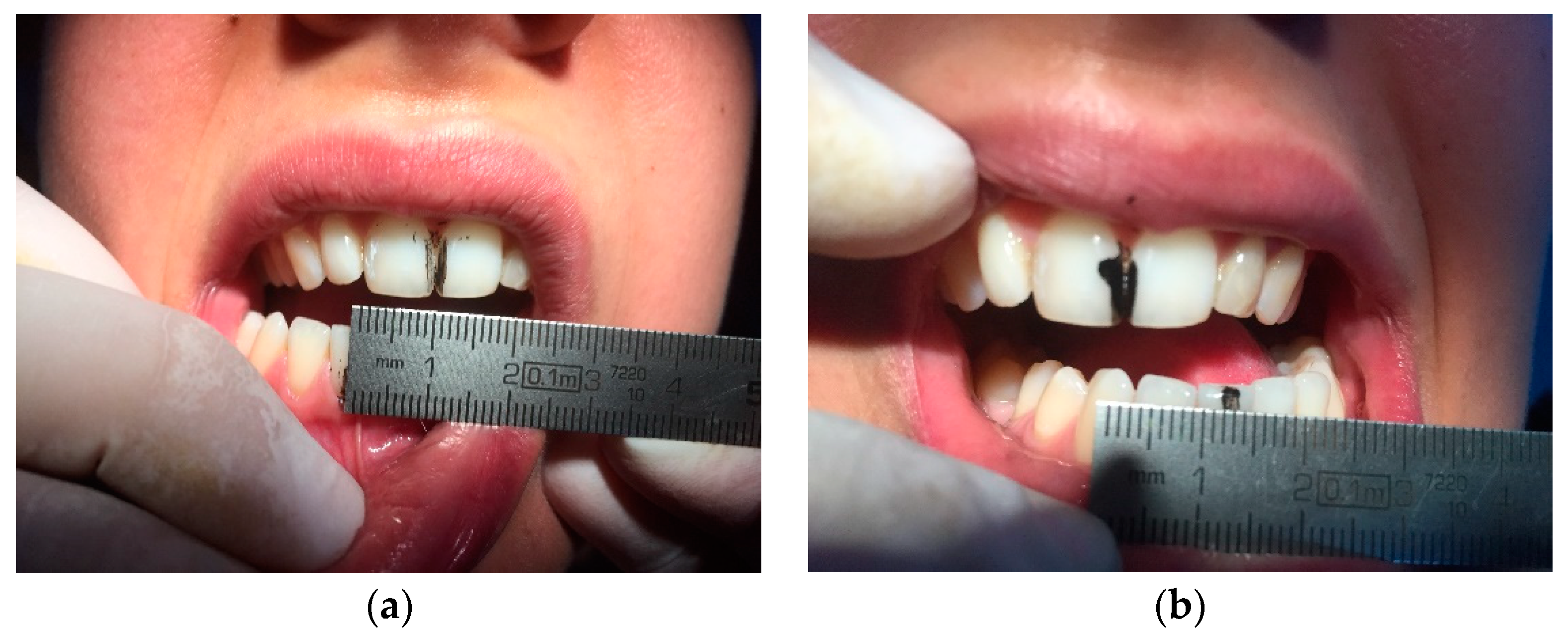 Wind Instrumentalists and Temporomandibular Disorder: From Diagnosis to ...