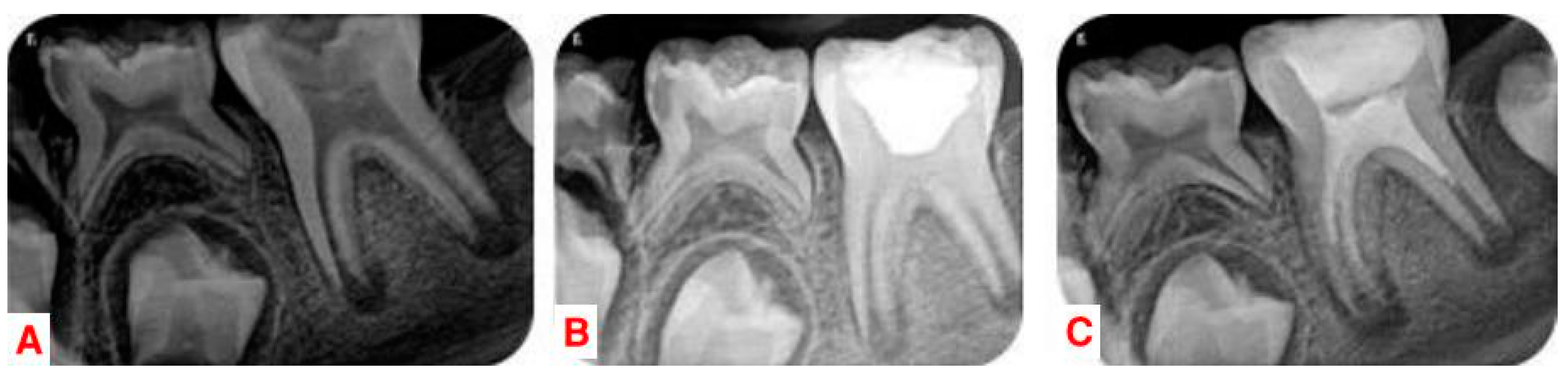 Management of an Immature Necrotic Permanent Molar with Apical ...