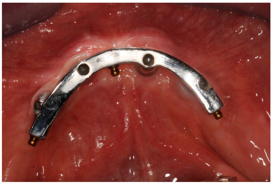 Effectiveness of Ball Attachment Systems in Implant Retained- and ...
