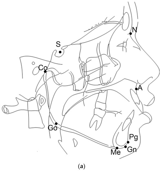 Distribution of the Condylion-Gonion-Menton (CoGoMe^) Angle in a ...