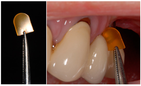 Treatment of Peri-Implant Mucositis with Repeated Application of ...