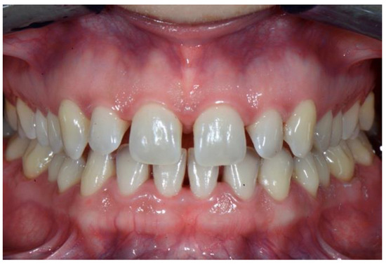 Minimally Invasive Diastema Restoration with Prefabricated Sectional ...