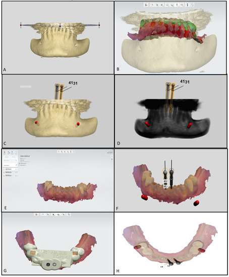 Guided Endodontic Treatment of Calcified Lower Incisors: A Case Report