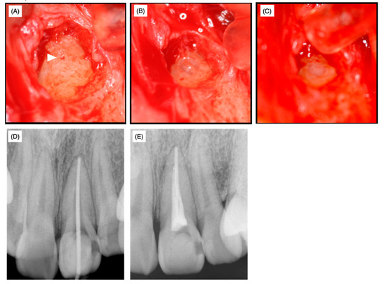Surgical Sealing of Laterally Localized Accessory Root Canal with Resin ...