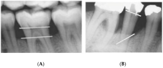 Development of a Radiographic Index for Periodontitis
