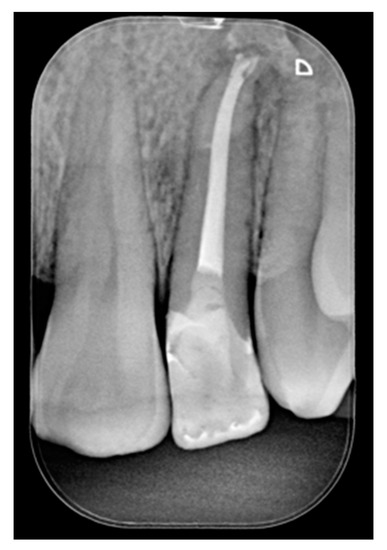 Dentistry Journal | Free Full-Text | The “Pre-Finishing” Approach in ...