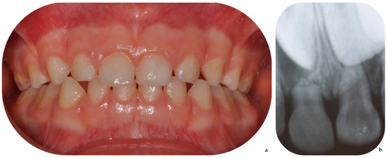 Root Fracture and Extrusive Luxation in Primary Teeth and Their ...