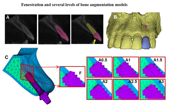 Impact of Bone Augmentation of Facial Bone Defect around ...