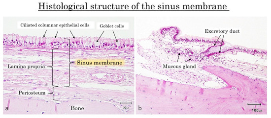 A Reliable Surgical Procedure for Sinus Floor Augmentation with Antral ...
