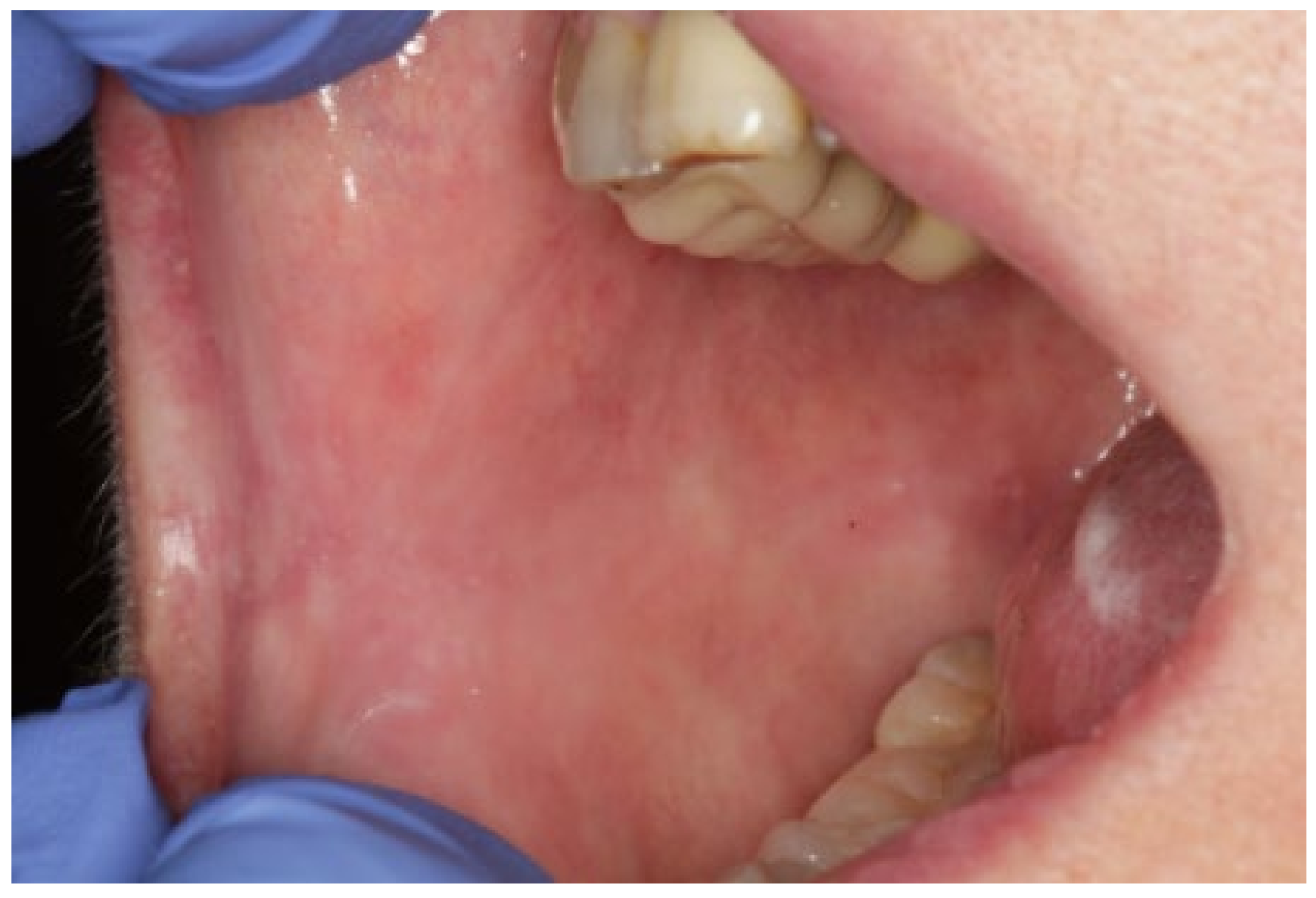 Mucous Membrane Pemphigoid Oral