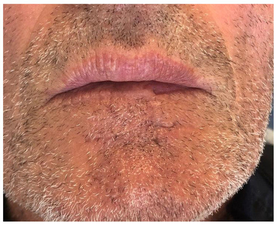 Lip Reconstruction by Double Layer and Double Flap New Combination ...