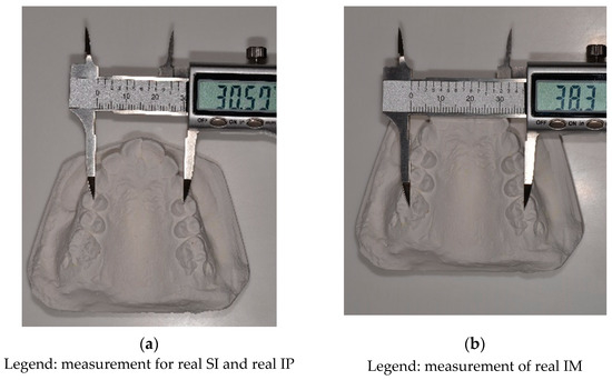 Testing the Accuracy of Pont’s Index in Diagnosing Maxillary Transverse ...