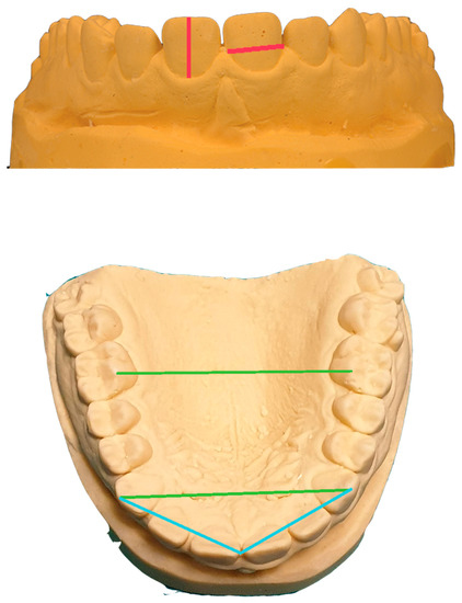 Digital Dental Models: Is Photogrammetry an Alternative to Dental ...