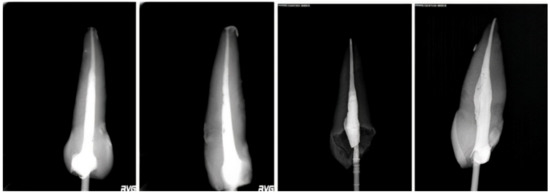 Comparison of Two Root Canal Filling Techniques: Obturation with ...