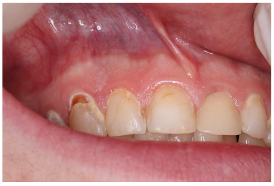 The Correlation of Swedish Snus, Nicotine Pouches and Other Tobacco ...