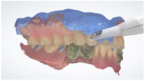 Digital Workflow for Edentulous Patients with Implant-Supported Fixed ...