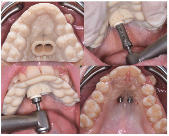 Comparing Distal-Jet with Dental Anchorage to Distal-Jet with Skeletal ...