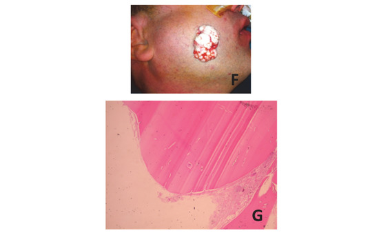 Peripheral Osteoma of the Mandibular Condyle—Case Series